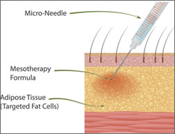 mesotherapy treatment at our dermatologists office in Pittsburgh ...